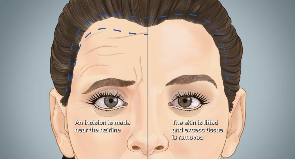 Forehead Lift - Fidel Clinic