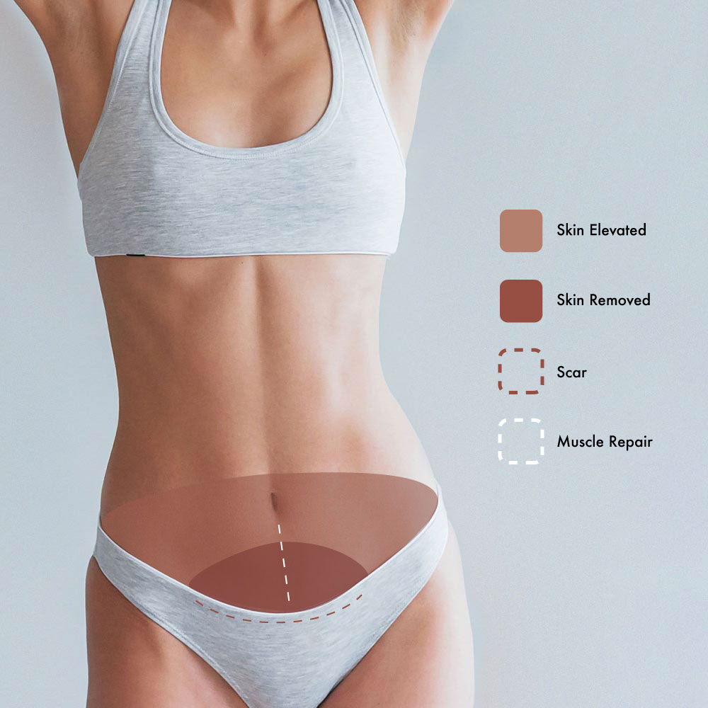 Tummy Tuck - Fidel Clinic